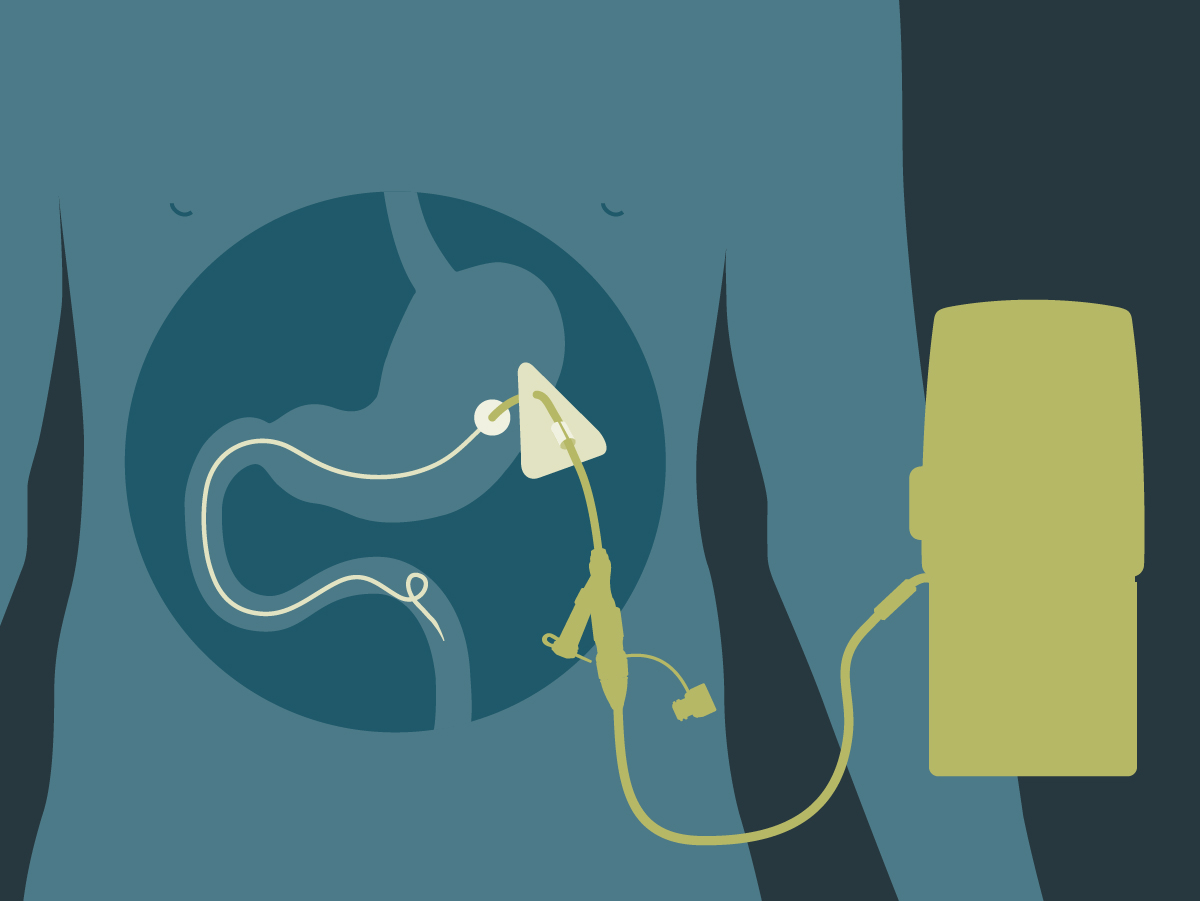 Advanced Parkinson’s Disease - Lobsor PHARMACEUTICALS